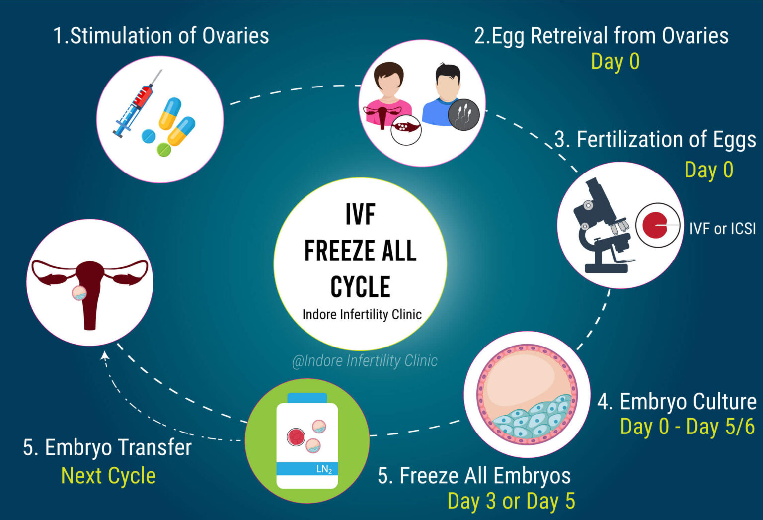What is Freeze All IVF Cycle? | Indore Infertility Clinic