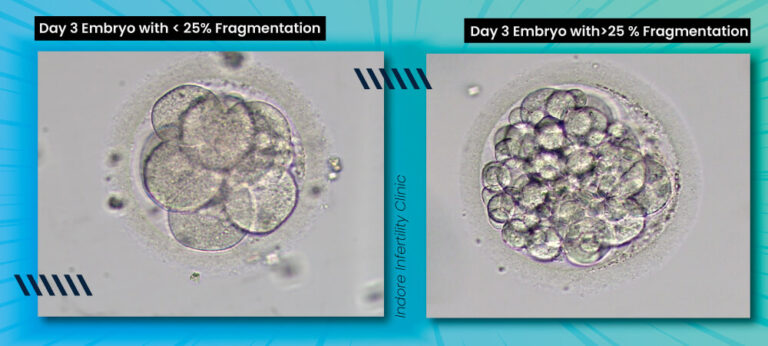A Patient’s Guide to Embryo Grading - How Good Are My Embryos?